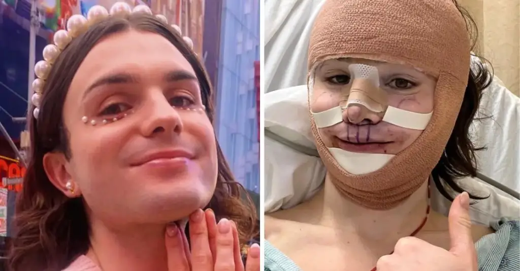 TikTok Star Dylan Mulvaney Reveals Results Of Facial Feminisation Surgery